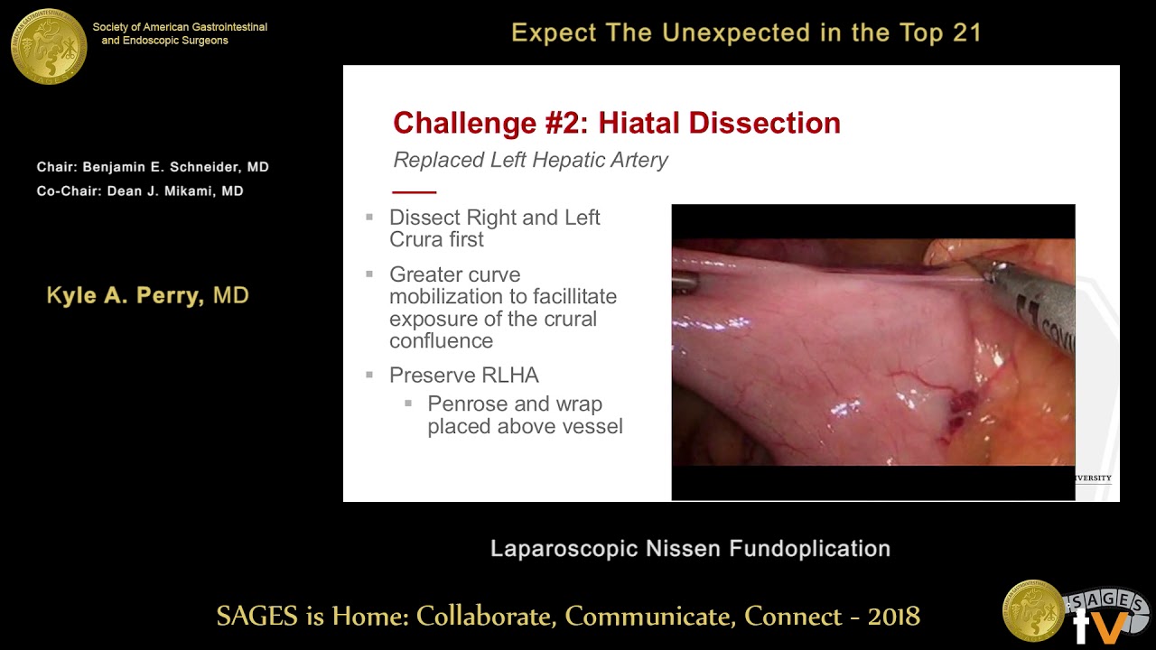 Laparoscopic Nissen fundoplication - YouTube