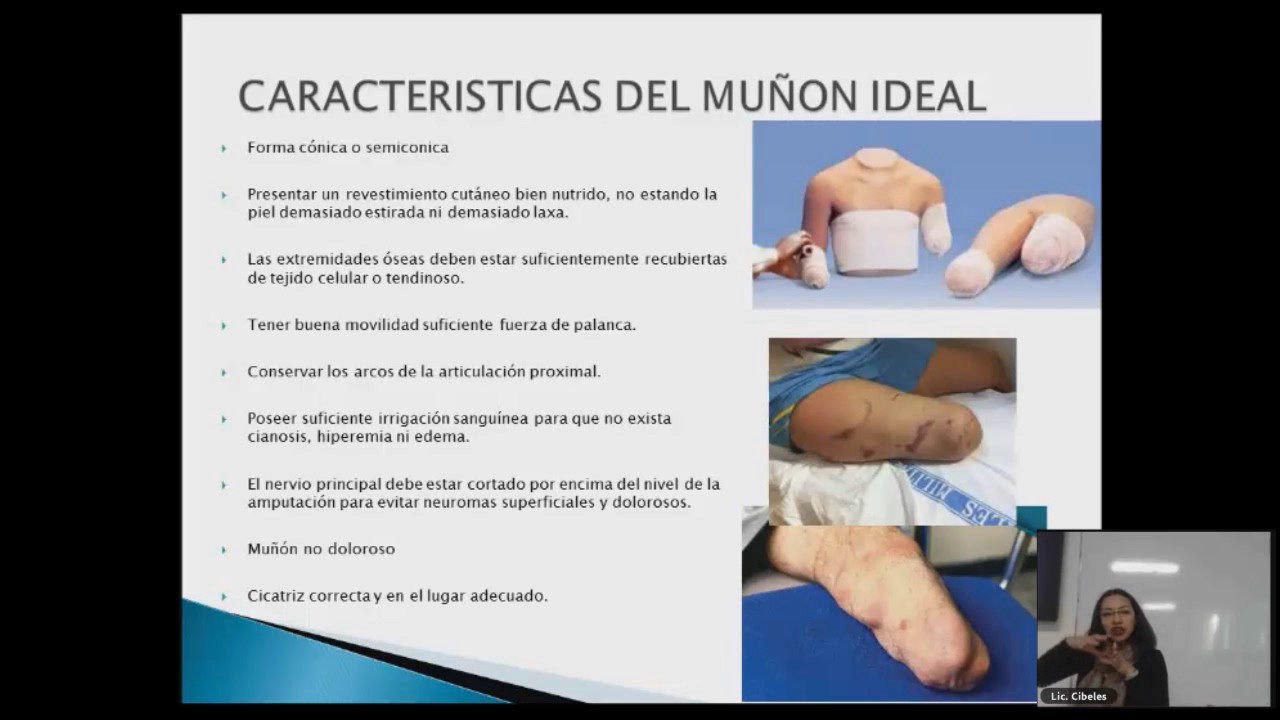 Fisioterapéutica en el paciente amputado Lic- Cibeles Peralta - YouTube