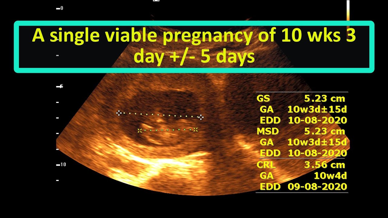 Ultrasound cases 37 of 2000 - || Video Showing A single viable ...