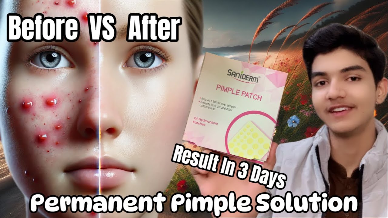 Permanent Pimple Solution In 3 Days | Cure Your Acne In 3 Days | تین ...