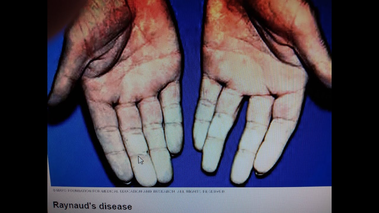 Raynaud's Disease, Syndrome, Phenomenon Explained And OTC Supplements ...