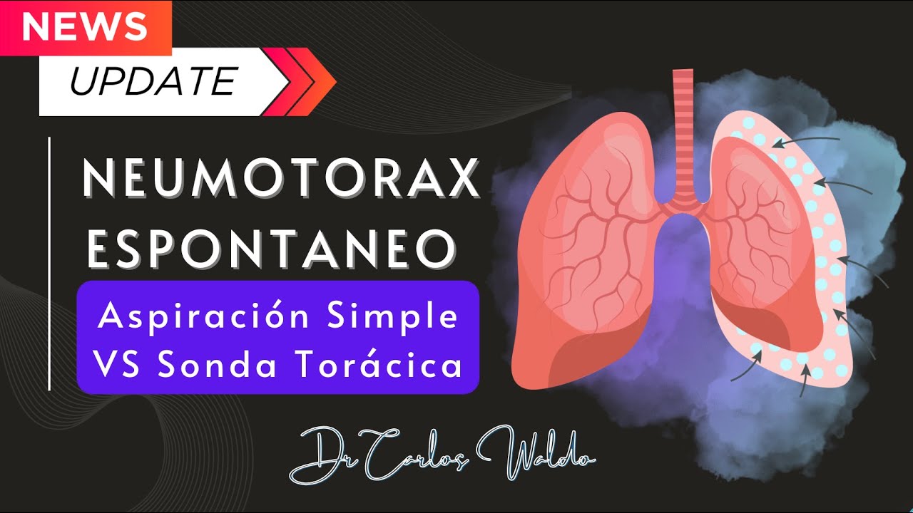 NEUMOTORAX ESPONTANEO Aspiración simple VS Sonda torácica - YouTube