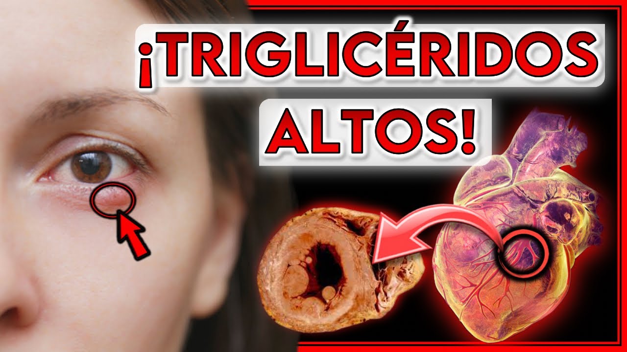 Trigliceridos Muy Altos – Trigliceridos Altos Causas – BZCQL