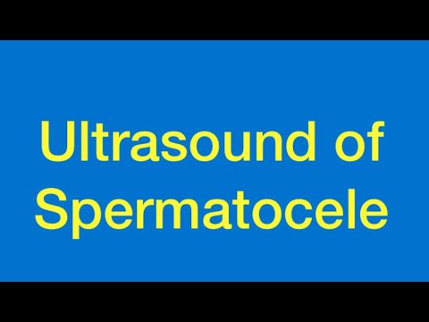 Ultrasound of Spermatocele - YouTube