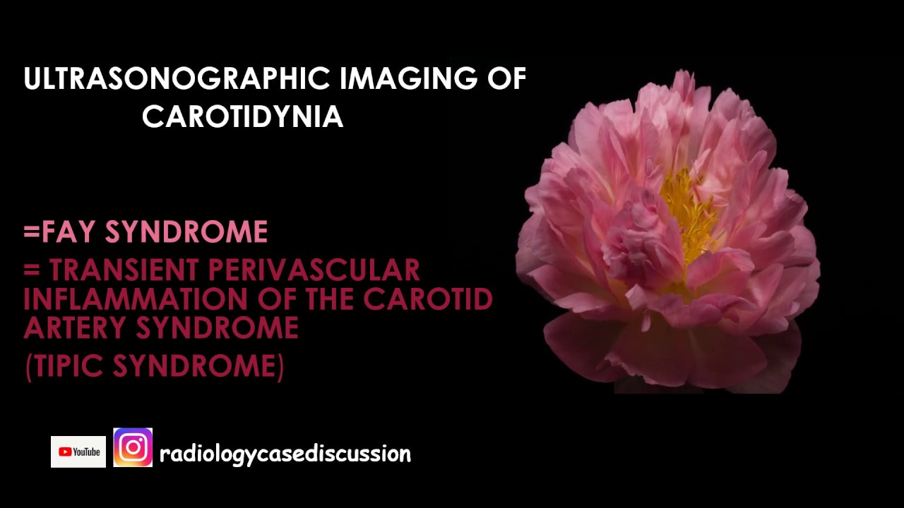 1-🟣💉CAROTIDYNIA (= FAY SYNDROME = TIPIC SYNDROM)⚕️ULTRASONOGRAPHIC ...