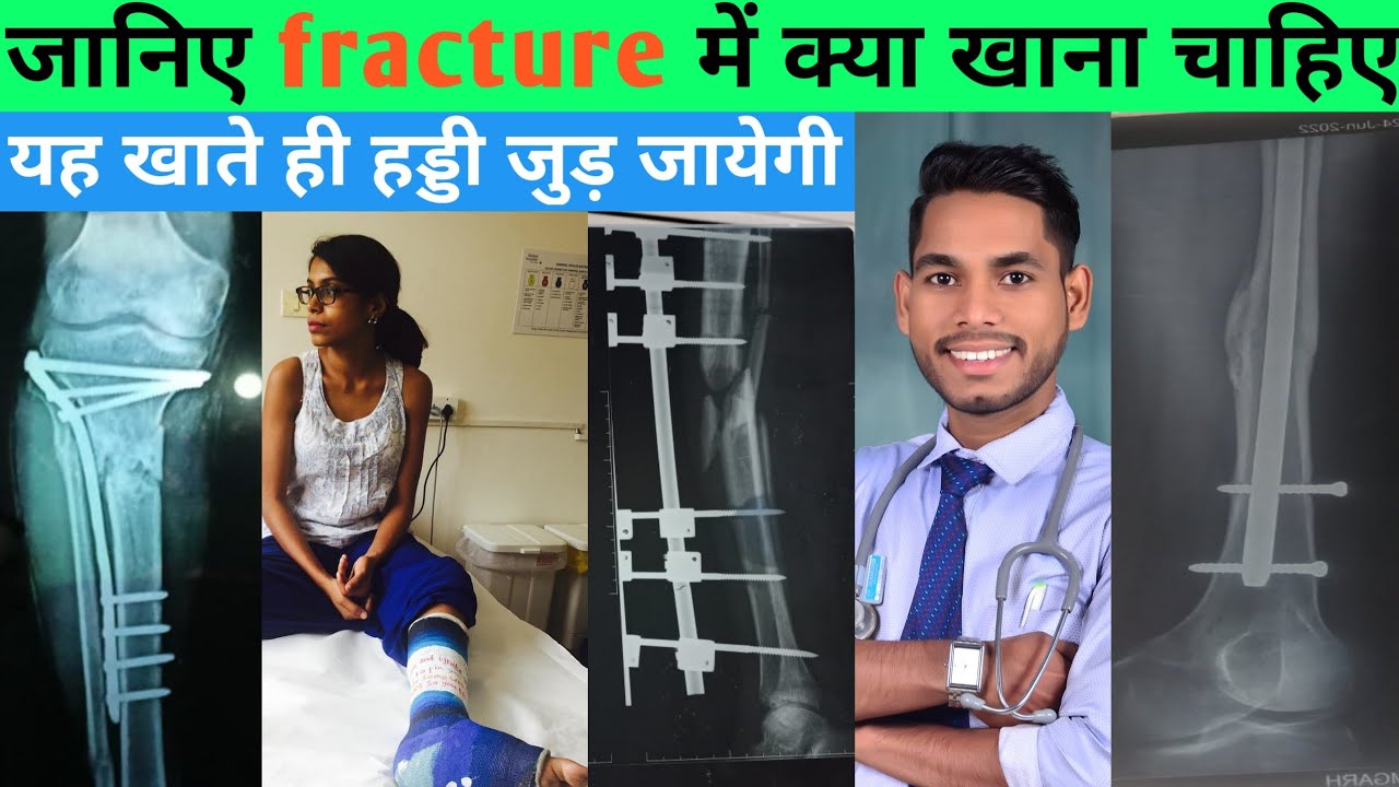 haddi jaldi jodne ke liye kya khana chahiye || haddi fracture ka ilaj ...