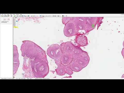 CONDILOMA ACUMINADO - YouTube