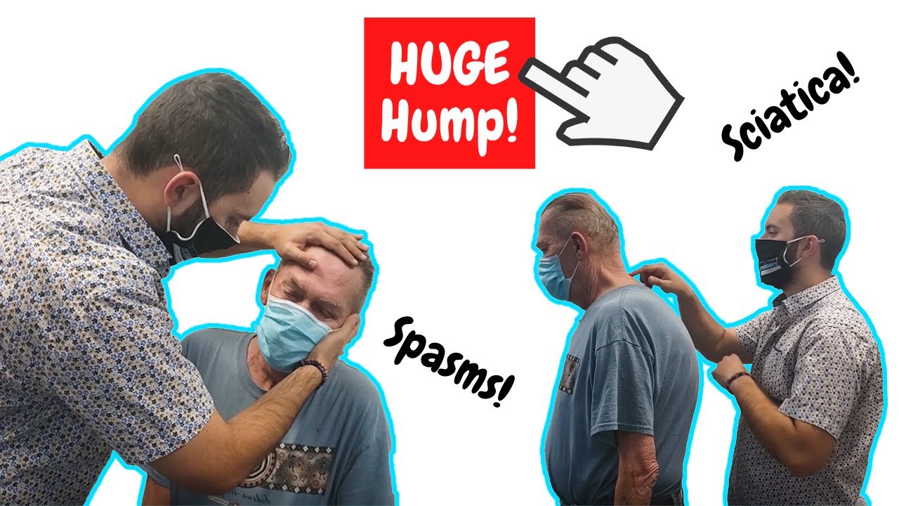 HUGE HUMP Shrunk! Treatment with Advanced Biostructural Correction ...
