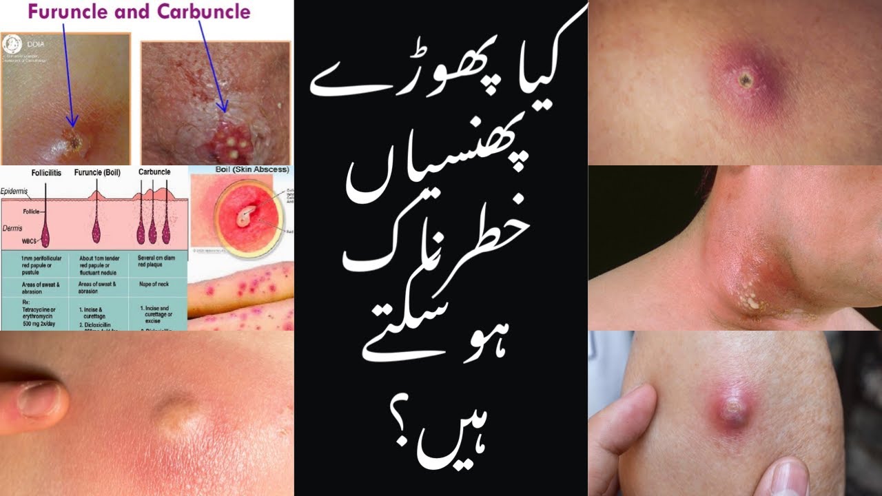 Furuncle and Carbuncle Urdu video - YouTube