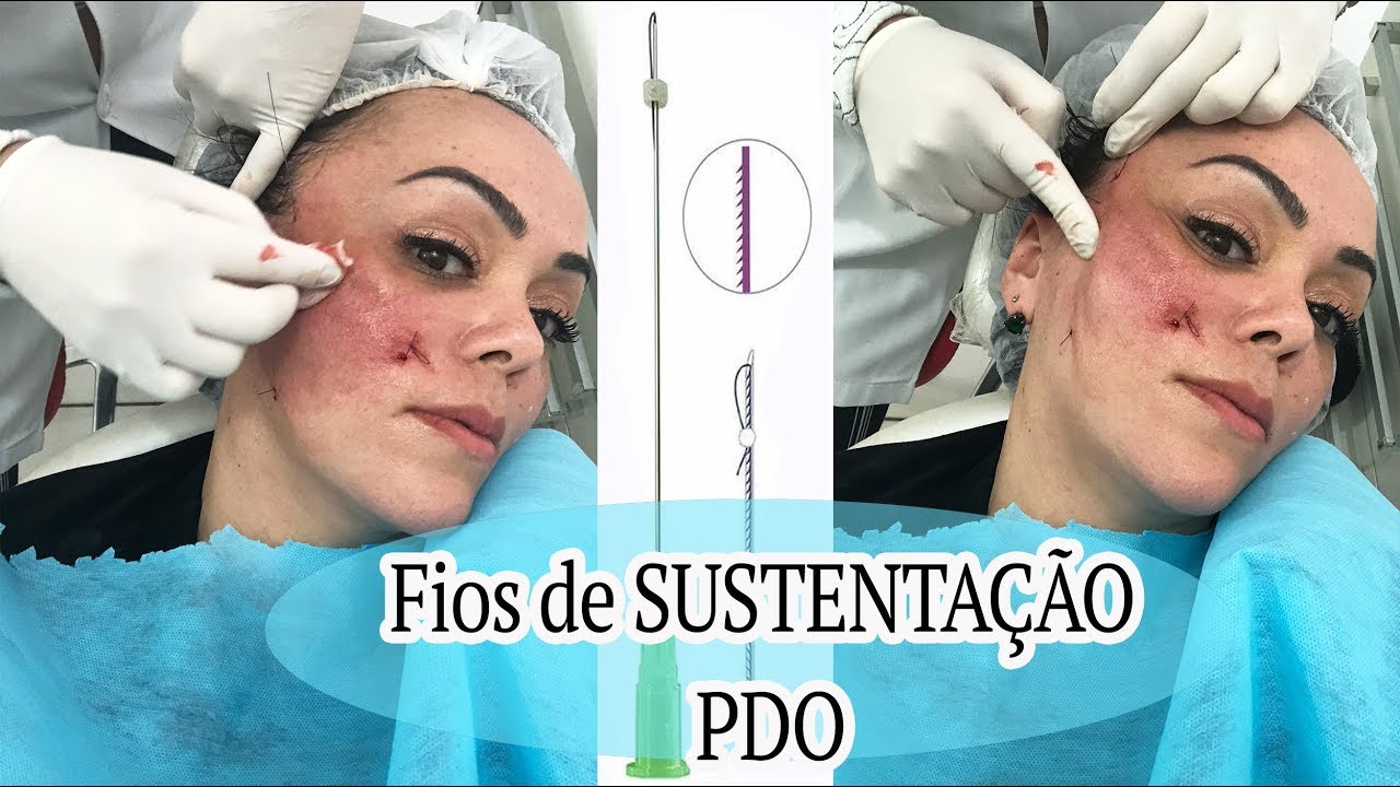 Fiz Fios de Sustentação no Rosto! - YouTube