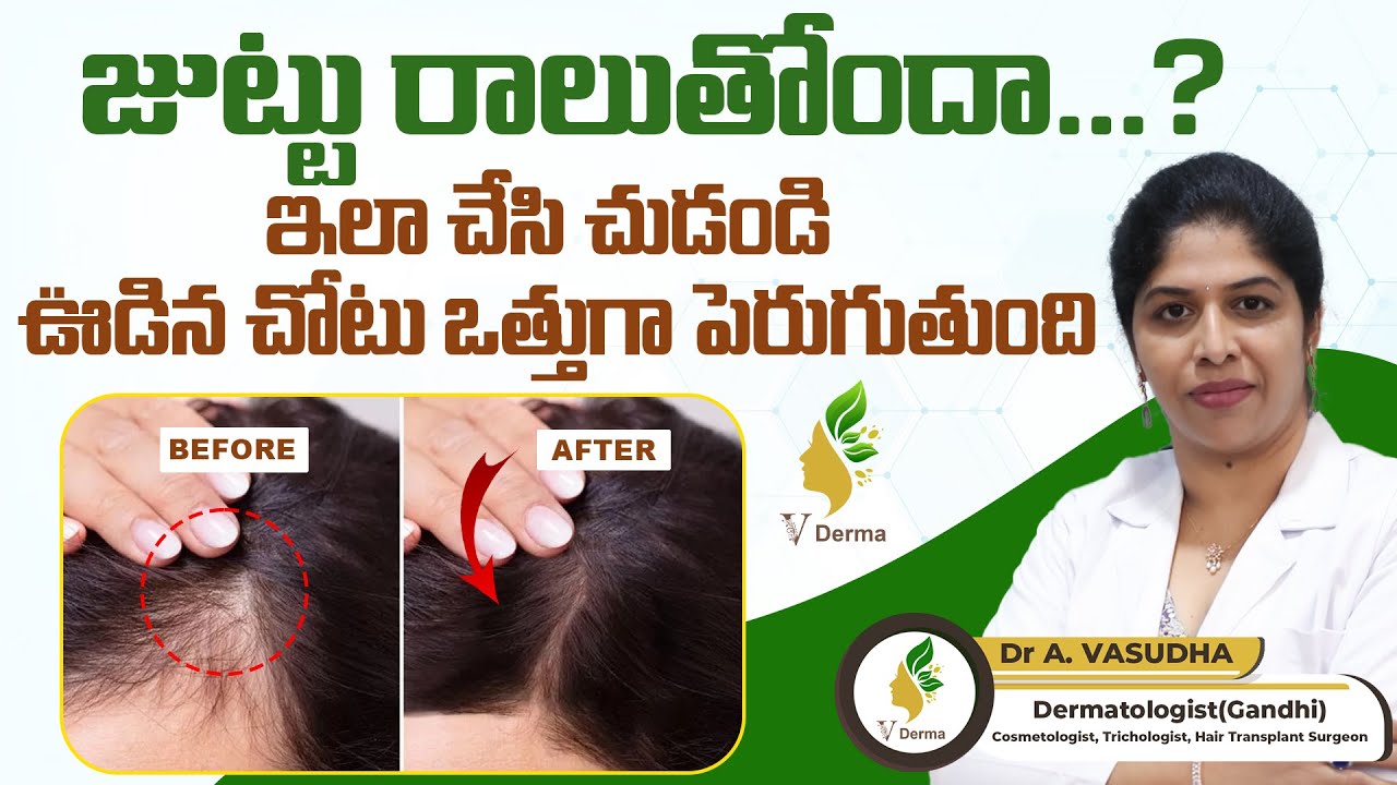 జుట్టు రాలుతోందా || Hair Fall Solution | Hair Fall Control Tips || V ...