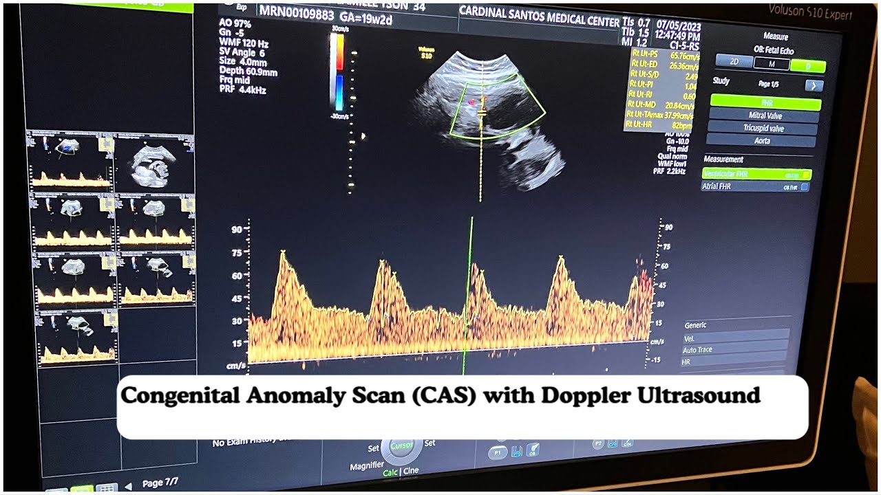 CONGENITAL ANOMALY SCAN (CAS) WITH DOPPLER ULTRASOUND | 19 WEEKS ...