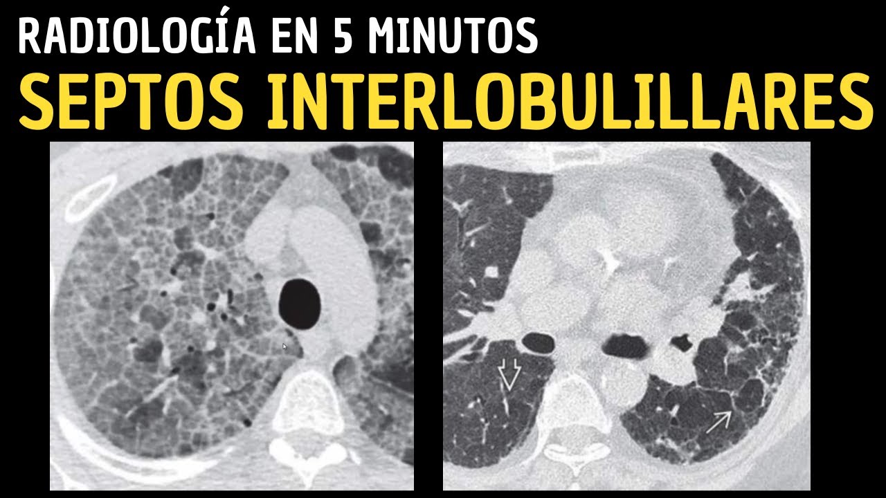 Radiología en 5 minutos: Signos radiológicos pulmonares: Septos ...