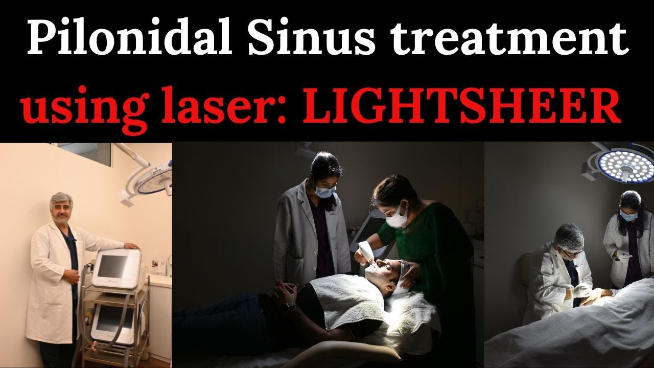Pilonidal Sinus treatment using laser: LIGHTSHEER || Advanced Wellness ...