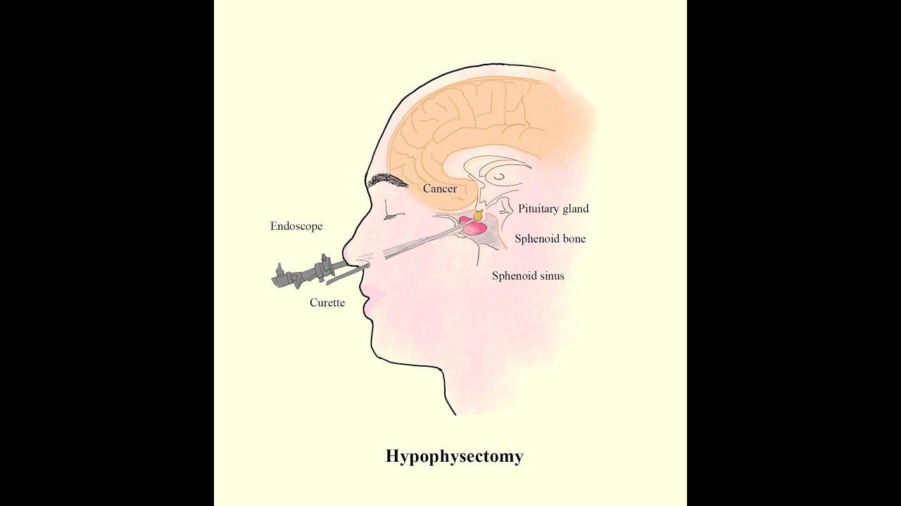 Craniotomy For Craniosynostosis CPT Code Simplify Medical Coding