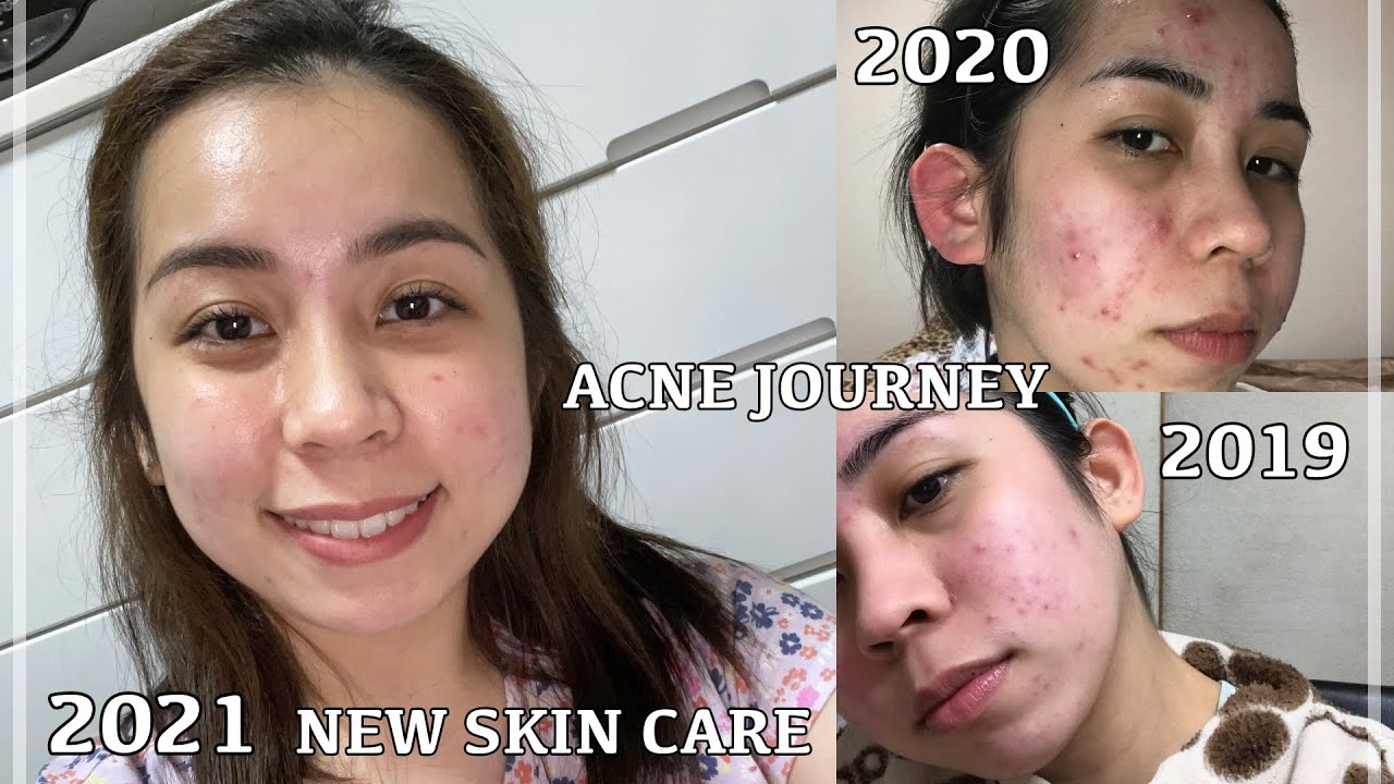 PAANO NAWALA ANG PIMPLES KO 2021 + ACNE JOURNEY 2019-2021 + NEW SKIN ...