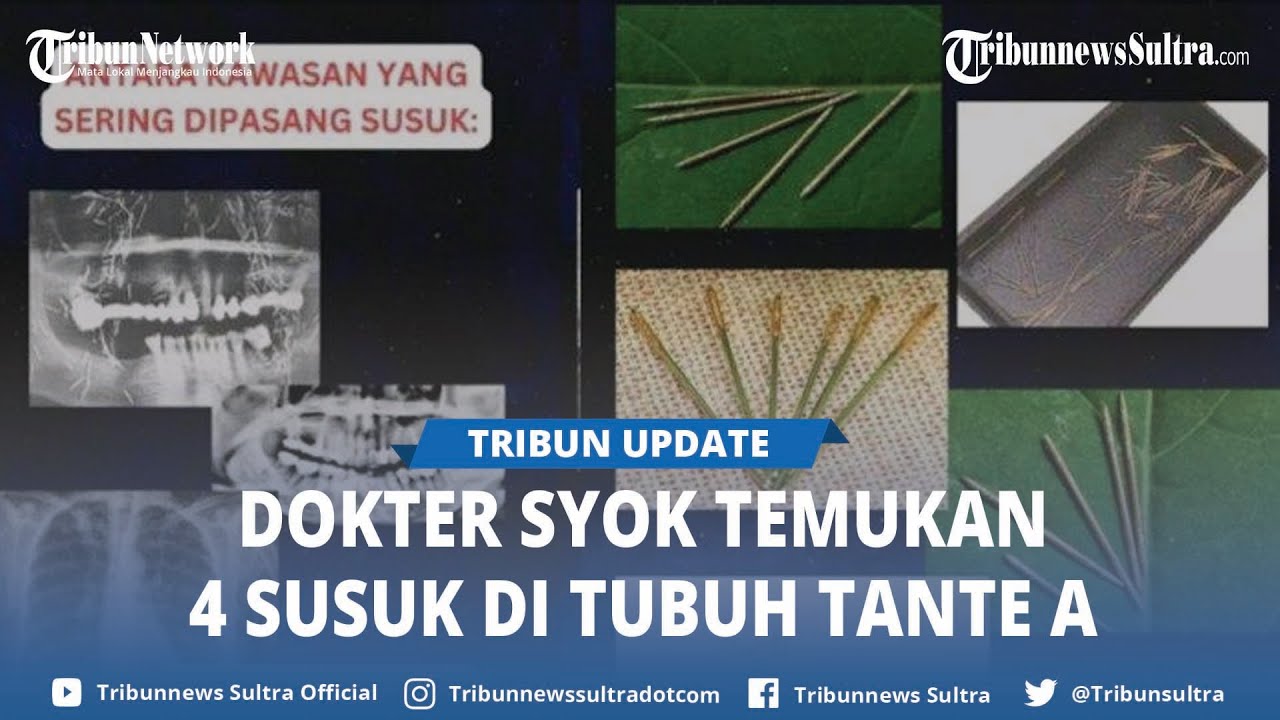 Dokter Syok Temukan Susuk di Tubuh Wanita Lumpuh, Terungkap saat X Ray ...