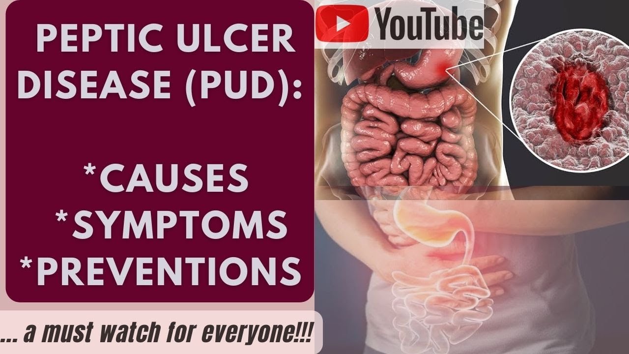 PEPTIC ULCER DISEASE: Causes I Symptoms I Preventions I First Aid - YouTube