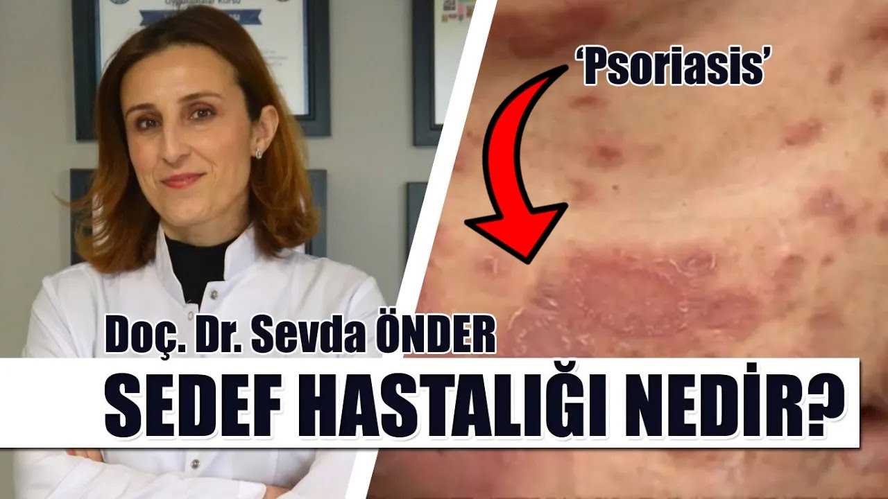 Sedef hastalığı nedir! Sedef hastalığının tedavi yöntemleri nelerdir ...