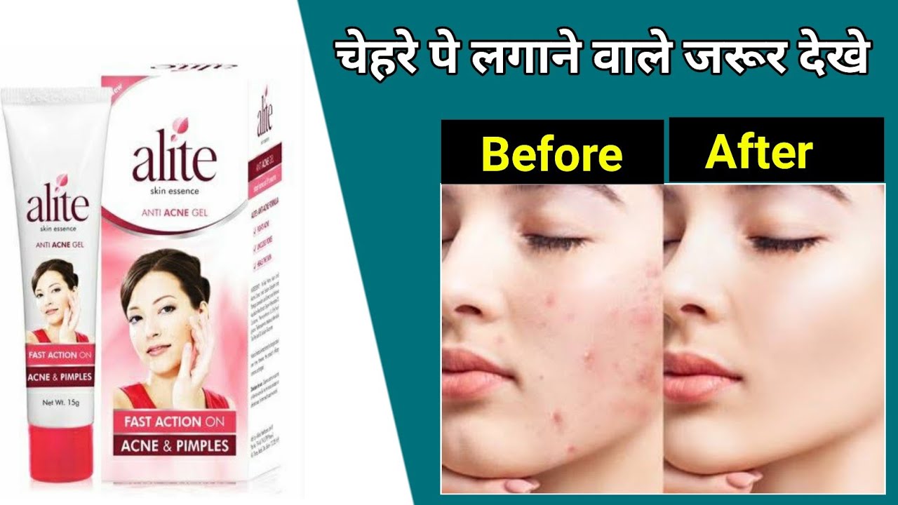 Alite cream uses in hindi/Alite anti acne gel side effects/Alite cream ...
