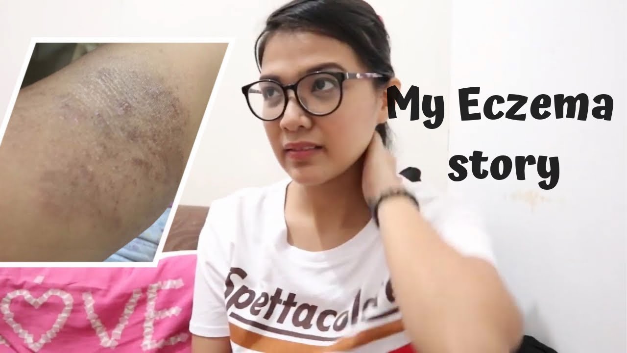 HOW TO GET RID OF ECZEMA OR ATOPIC DERMATITIS - YouTube