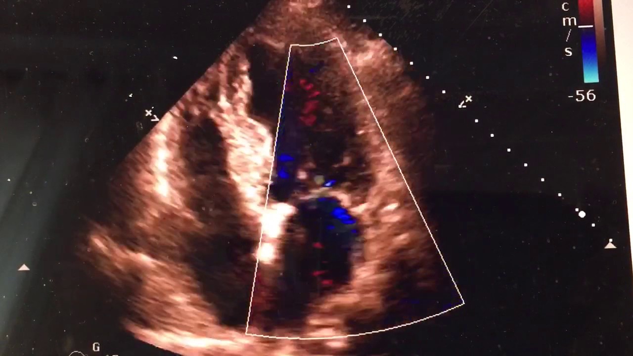 MQ Tube TTE septal bounce & LVH - YouTube