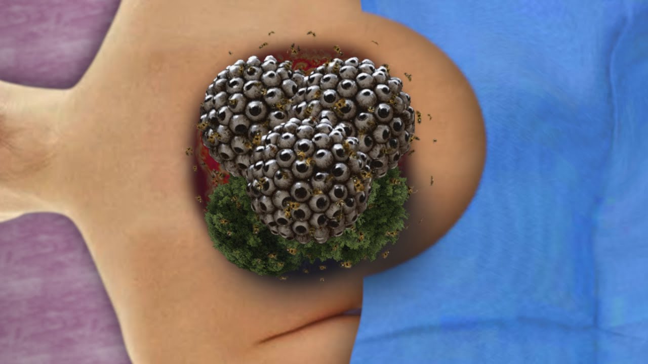 ASMR TREATMENT / Removing Maggots and Ticks From Infested Back / Deep ...