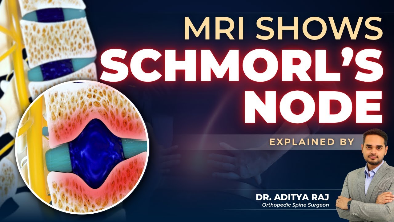MRI Shows Schmorl’s Node | Explained by Spine Specialist | Dr. Aditya ...
