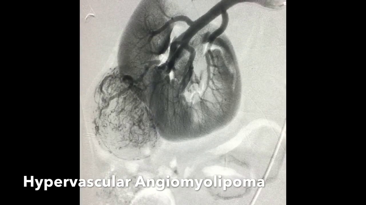 Renal Angiomyolipoma (AML) Transcatheter Ethanol (Alcohol) Embolization ...
