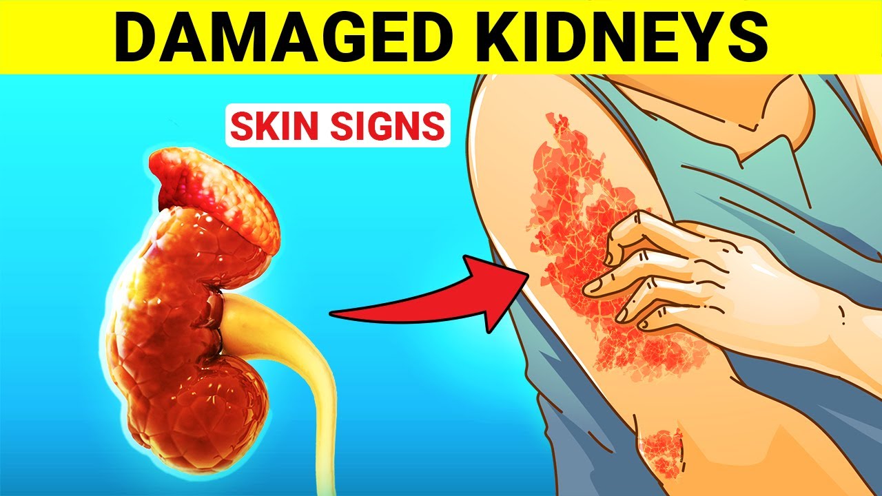 9 Skin Signs That May Indicate Your Kidneys Are Damaged - YouTube