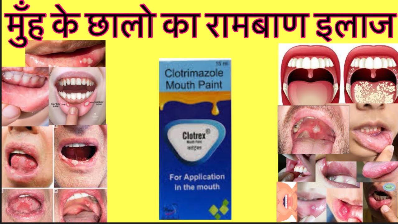 Clotrex Gel l Mouth Ulcers l Disorders of Gums l मसूड़ों में दर्द, मुंह ...