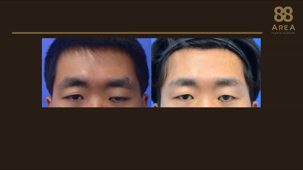 Using Conjoint Fascial Sheath (CFS) to treat severe blepharoptosis– 5 ...