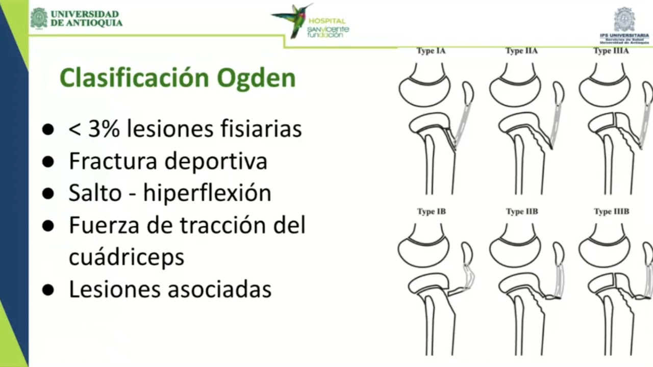 Fracturas tibia proximal en niños. Dr. Sebastian Callejas - YouTube
