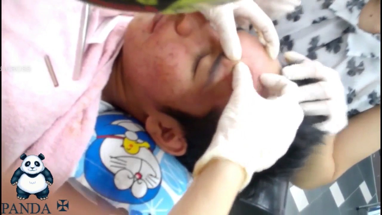 Extraction Of Blind Pimples And Acne On Face!! - YouTube