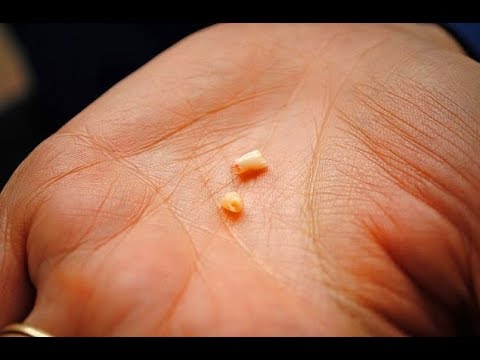 DOKTORLARIN HASTALARIN KULAKLARINDAN ÇIKARDIKLARI EN ACAYİP VE TİKSİNDİRİCİ 11 ŞEY, Garip Videolar