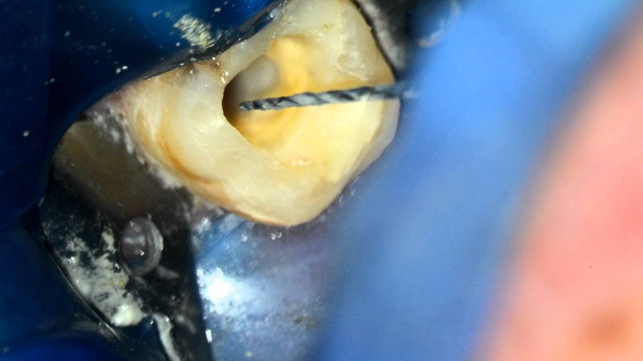 Rotary Root Canal Instrumentation with Vortex File - YouTube