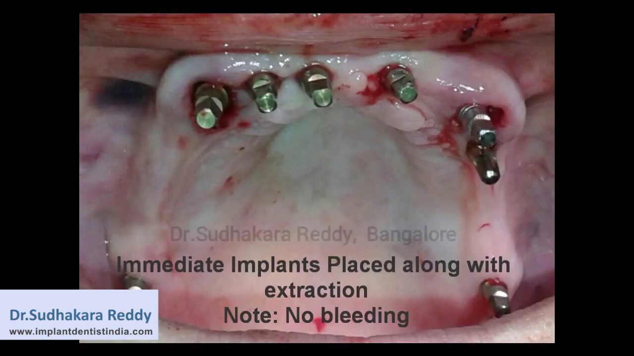 Full Mouth Rehabilitation with Basal Implants in Bangalore | Immediate ...