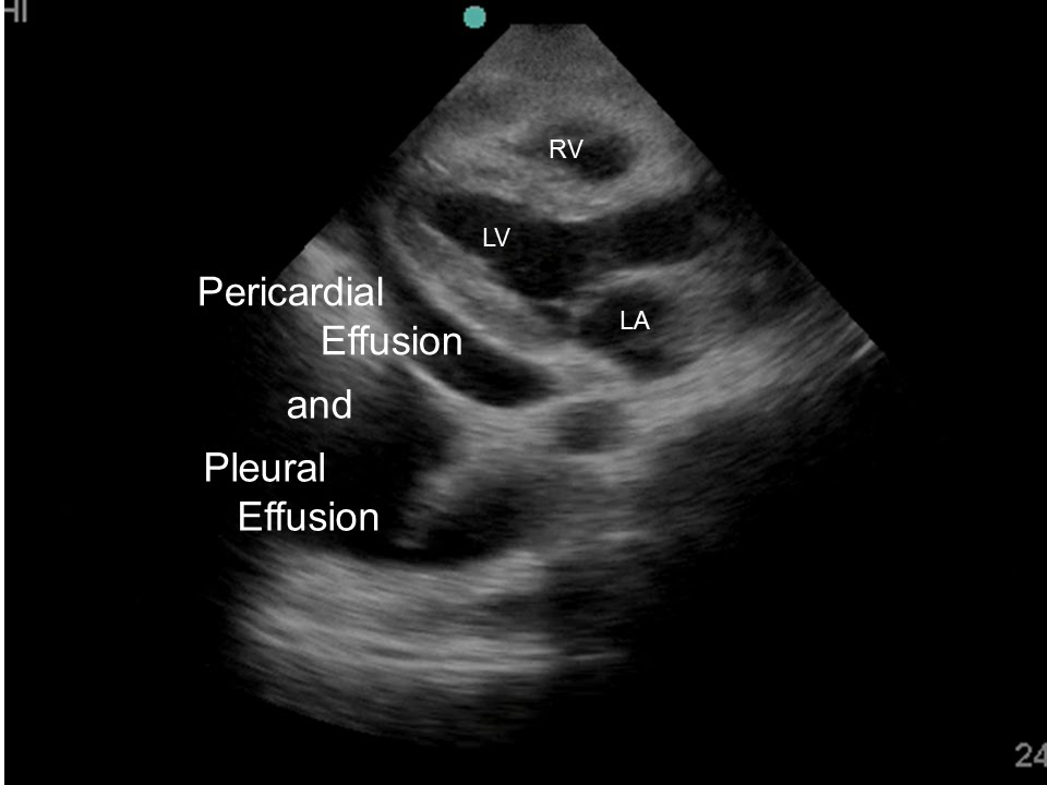 Ecg And Echocardiogram Showing Pericarditispericardial