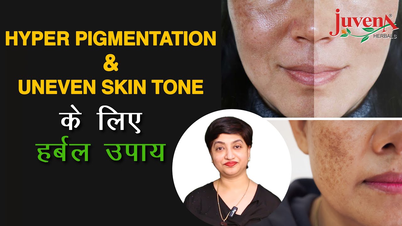 Hyperpigmentation Home Remedies | Juvena Herbals Expert Guide - YouTube