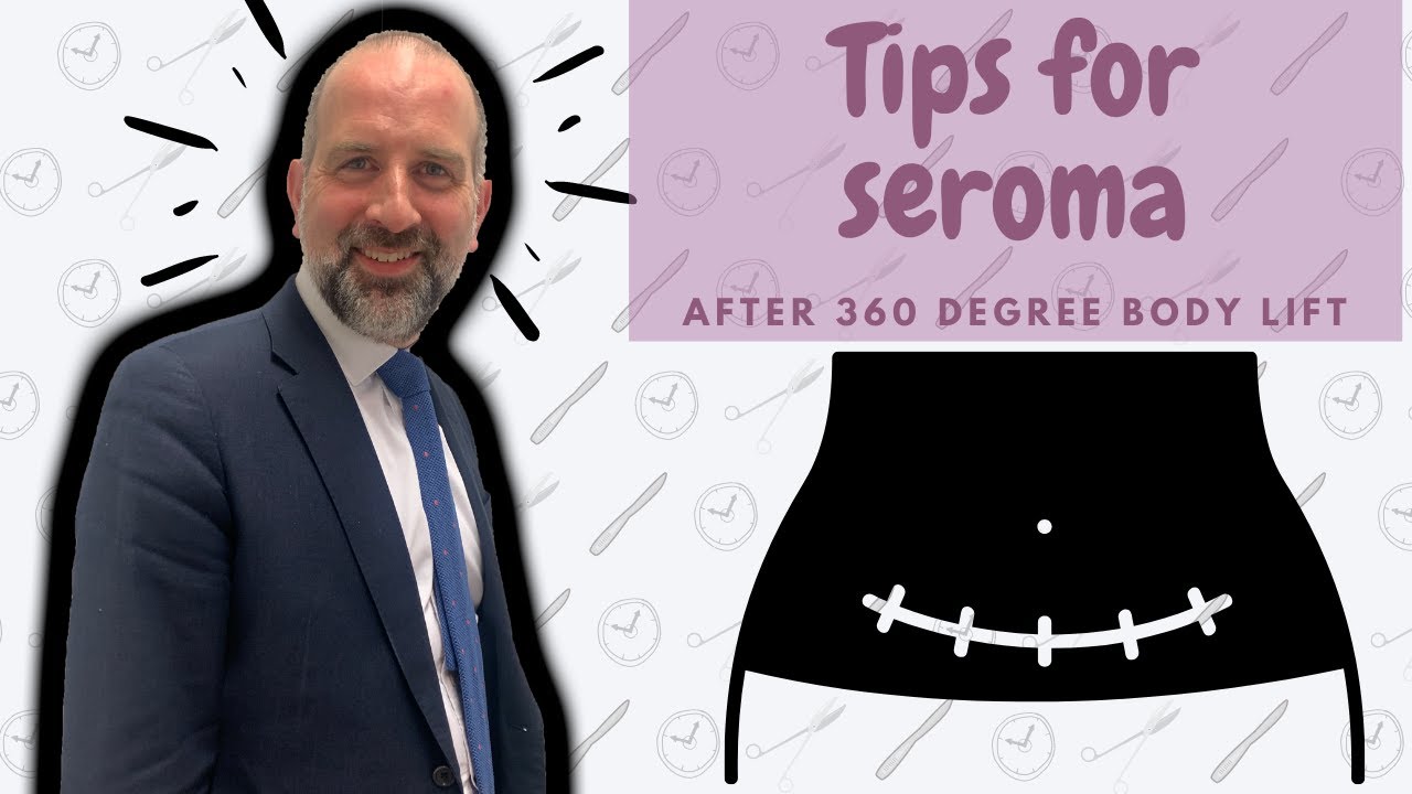 #ASKJJ - Tips for seroma after 360 degree body lift - YouTube