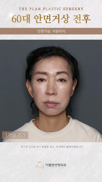 60대 안면거상술 전후사진 공개 3개월 후기 안면거상전후 안면거상술잘하는병원 60대안면거상 Youtube