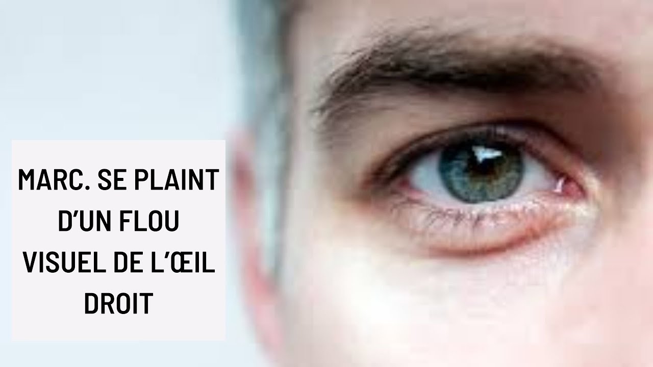 marc. se plaint d’un flou visuel de l’œil droit - YouTube