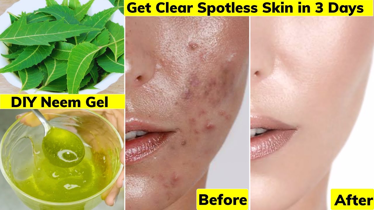 I applied👆🏼this Face Cream Gel on Acne, Pimples, Pigmentation,Bumps-Got ...