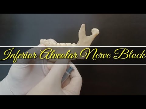 Inferior Alveolar Nerve Block | Lingual Nerve Block | Long Buccal Nerve ...