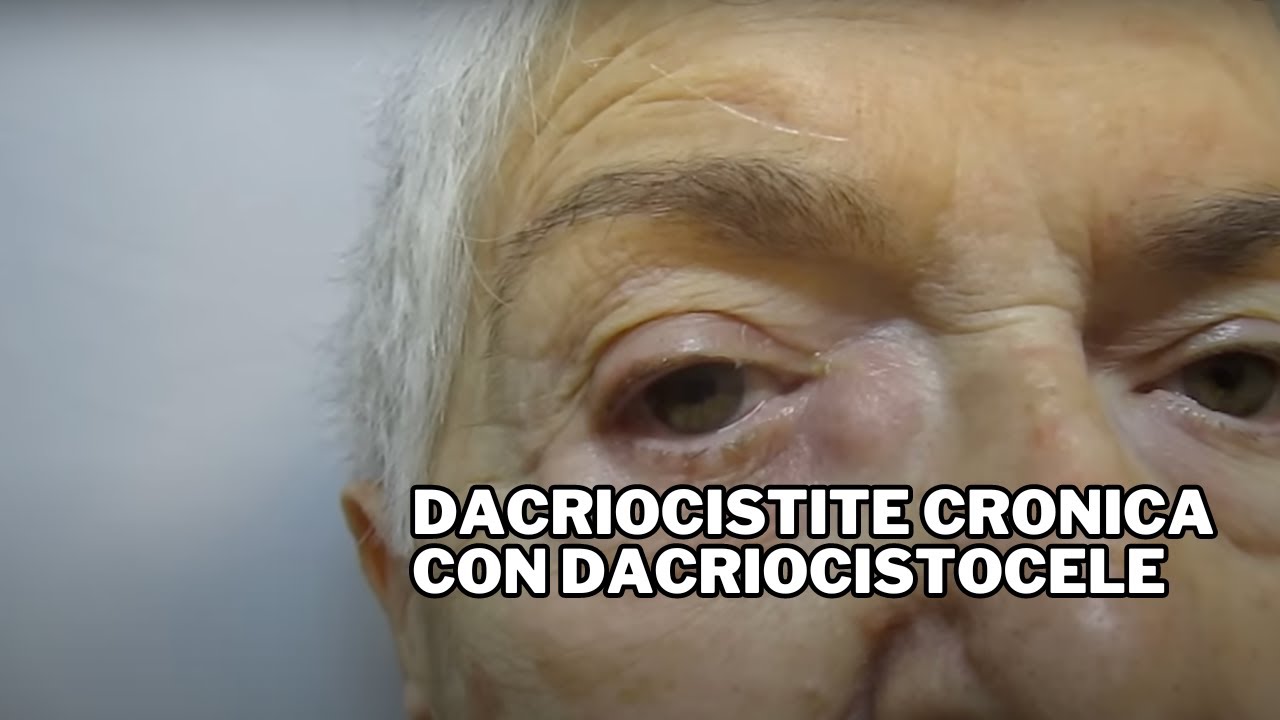 Dacriocistite Cronica con Dacriocistocele (sacco lacrimale gonfio ...