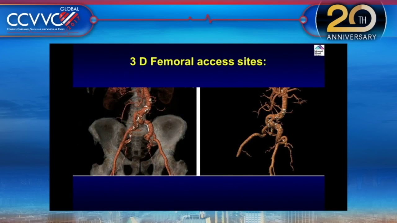 Live Case 12 - CoreValve TAVR for Bioprosthetic Stenosis - CCVVC 2017 ...