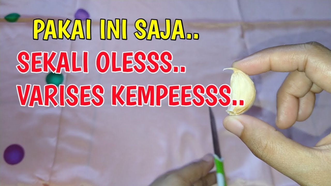 PAKAI INI SAJA ! Varises Di Betis Langsung Hilang,Begini Cara ...