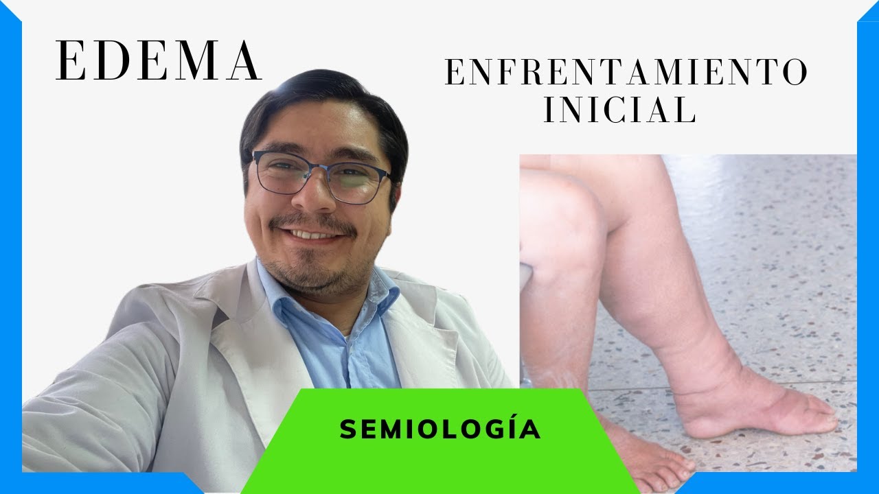 Edema o sindrome edematoso, 👨‍⚕️ enfrentamiento inicial, causas y ...