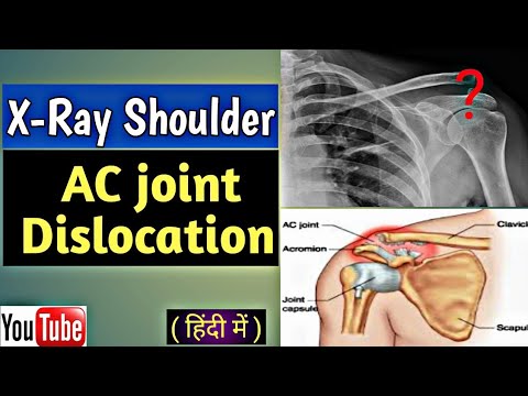 How to read shoulder Joint Dislocation on X-Ray // AC joint Dislocation ...