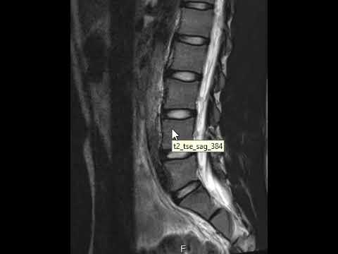 Pars defects - YouTube